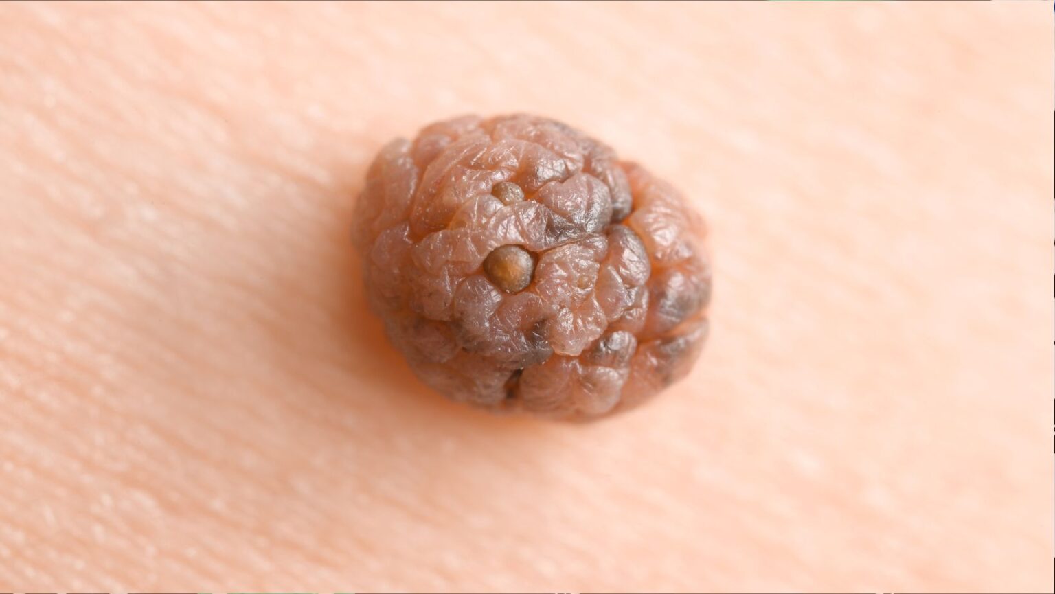 A Parent's Guide to Understanding Moles in Children - Debsllc